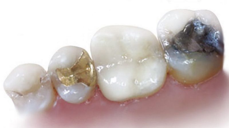 Empastes o Restauraciones Dentales - Clinica Dental Doctor Llaneza